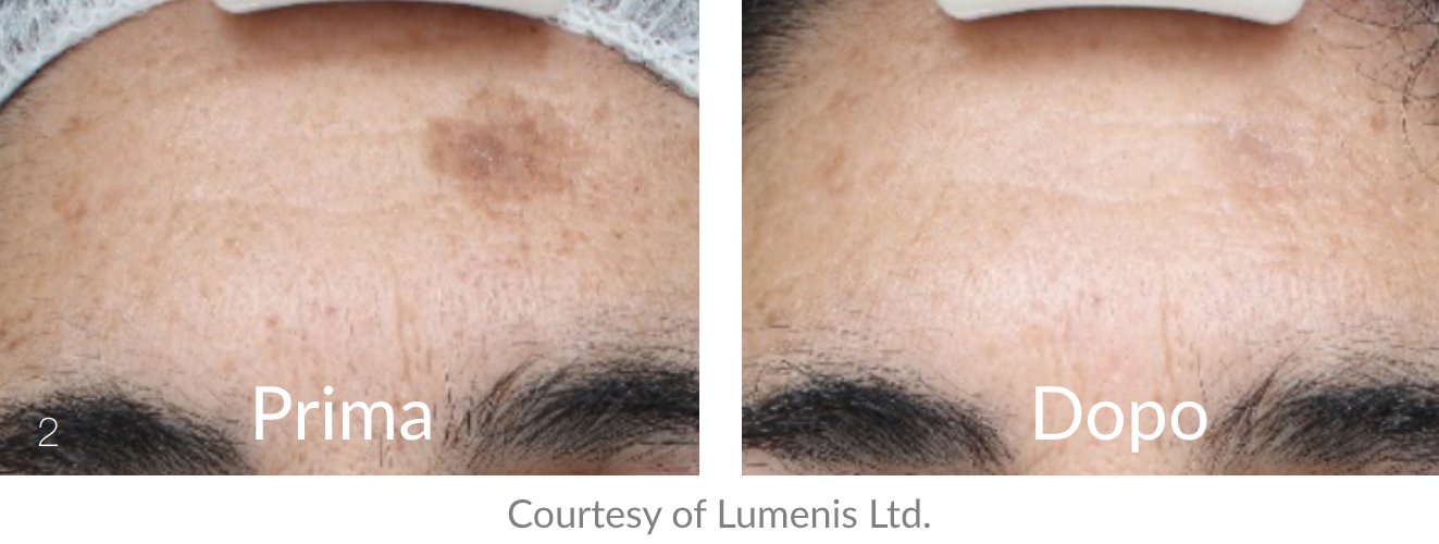 LightSheer QUATTRO è il sistema laser a diodo di Lumenis per epilazione ...